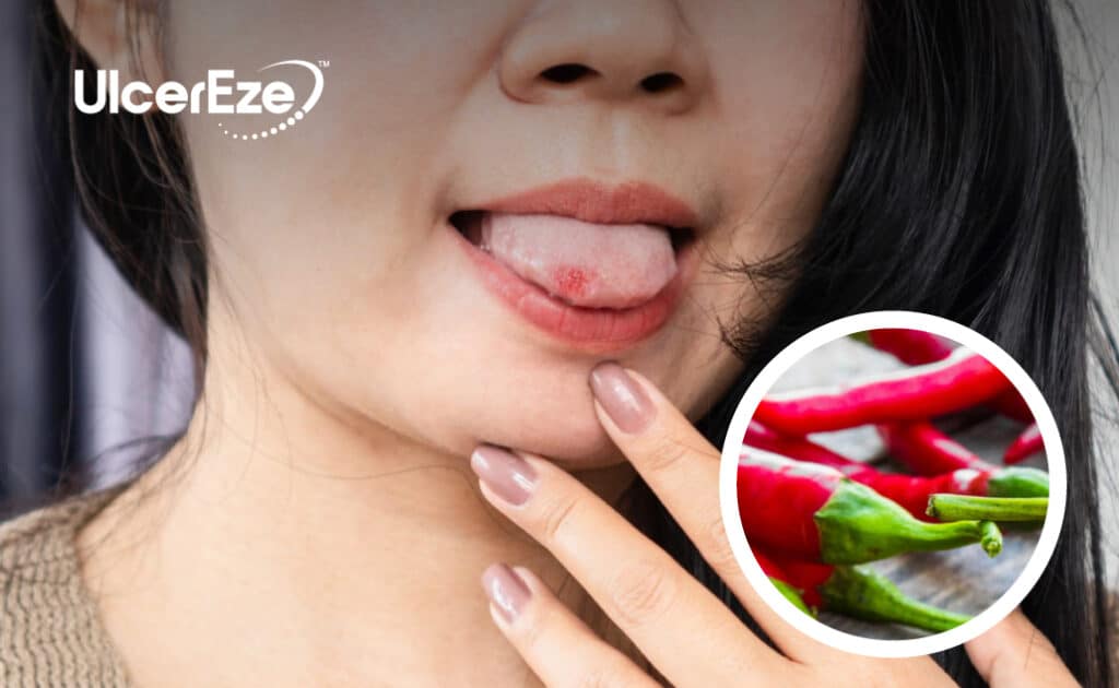 Mouth Ulcers: Causes and Prevention Tips | UlcerEze